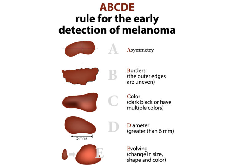 Skin Cancer: What You Need to Know | Estelle.edu
